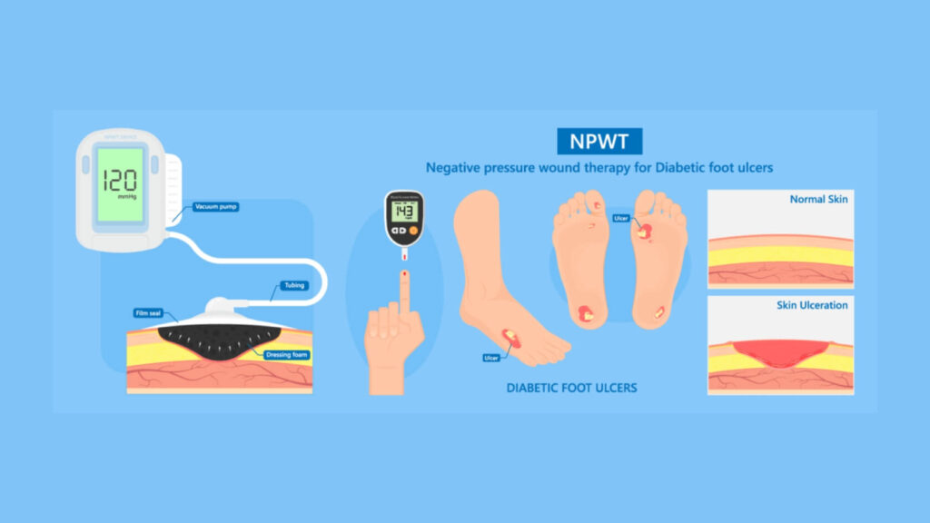 How Negative Pressure Wound Therapy (NPWT) Speeds Up Healing